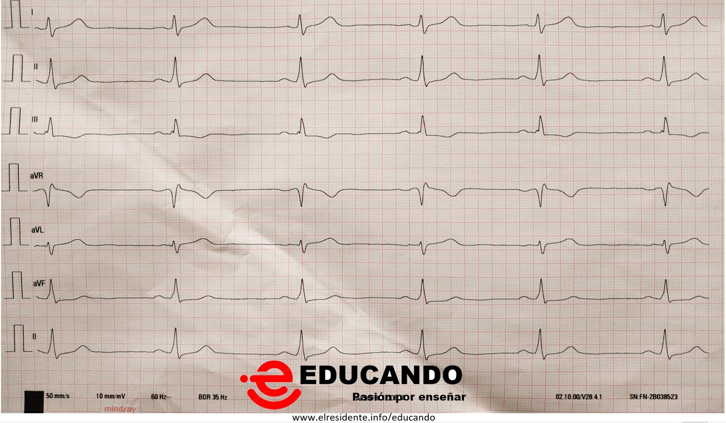 ECG 18-03-2024 - Educando